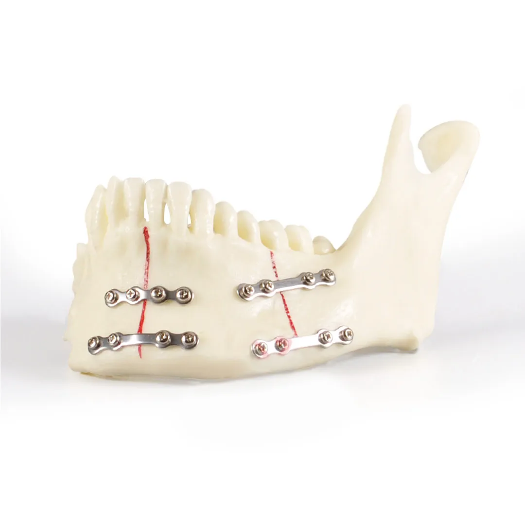 iDENTical Jaw with Titanium Plate Model M5001 - Mandibular Fracture ...