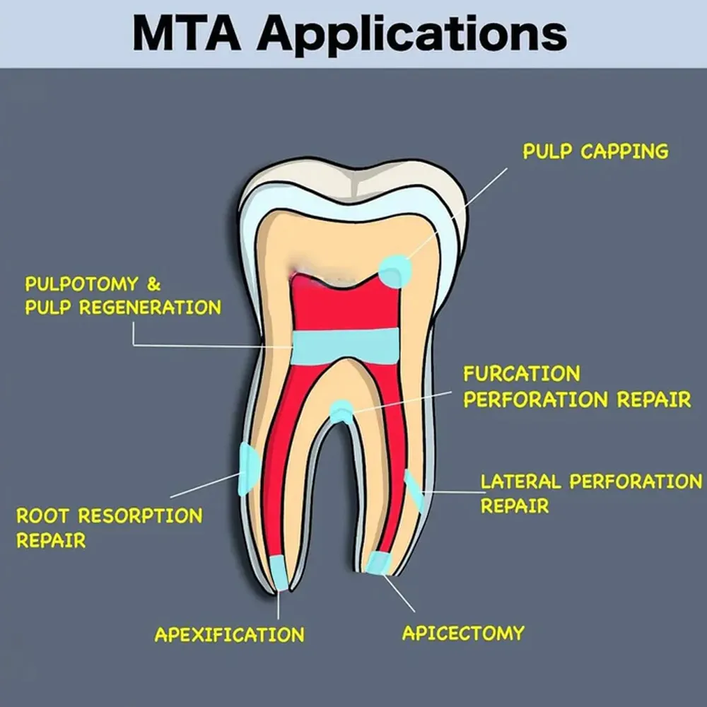 Prime Dental MTA Bio Putty