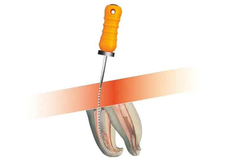 Buy Neoendo Neoprobe Files Online at Best Price | Dentalkart.com