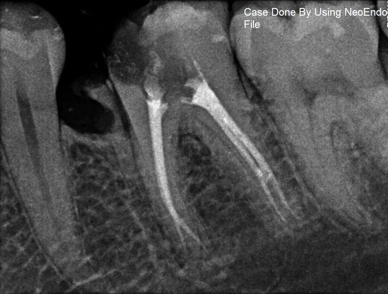 NeoEndo Flex Rotary Files 25mm | Highly Flexible NiTi Heat-Treated ...