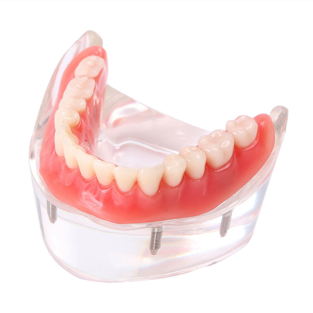 Buy Identical Mandibular Overdenture Model with 4 Implants | Maxillary ...