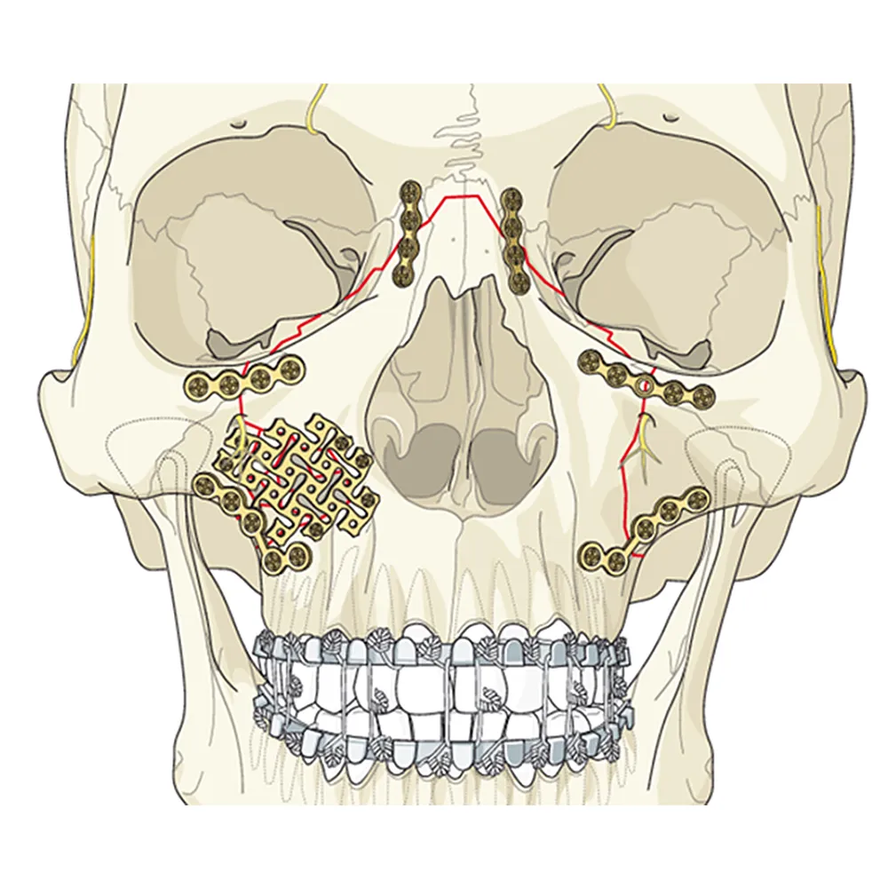 SK Surgicals Titanium Mini Plates Orbital Continuous - 1.5mm