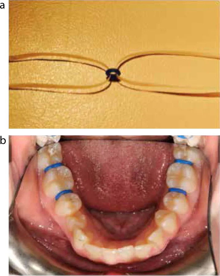 OrthoMetric Elastomerics Ring Seperator