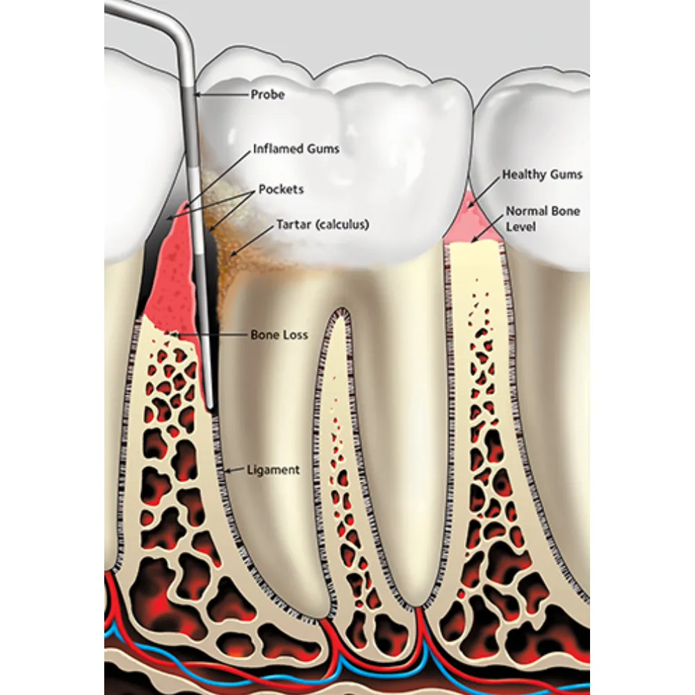 GDC Single End Probes Marquis Color Coded #6 (Pcp12) Online at Best ...