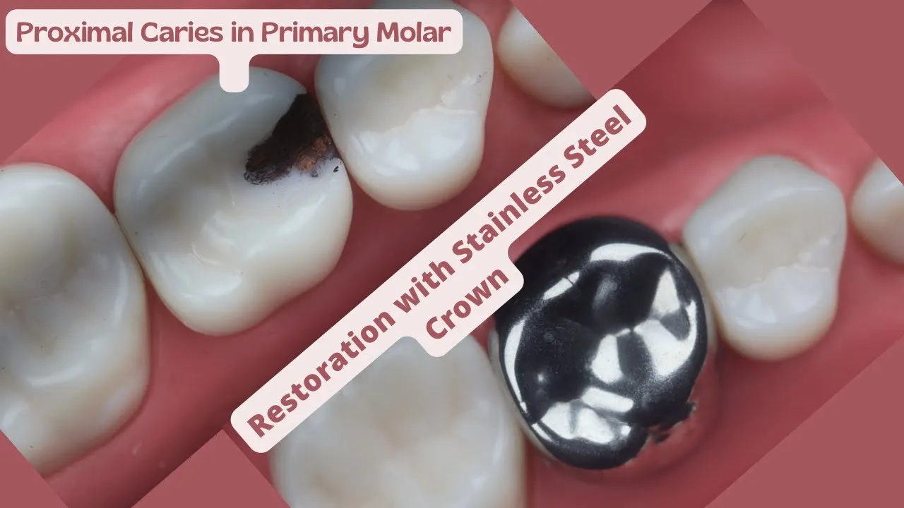 3M Espe SS Crown Primary Molar Crown-D (1st molar) Online at Best Price ...