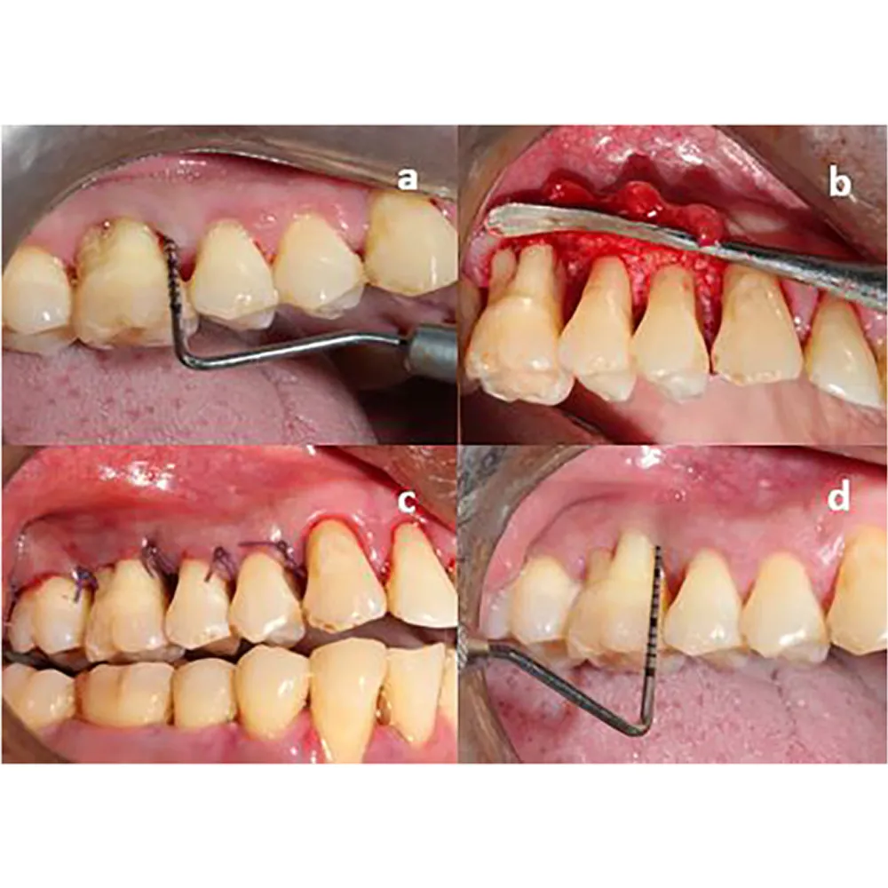 Buy the quality GDC Perio Surgical S-12 Kit online at Dentalkart.