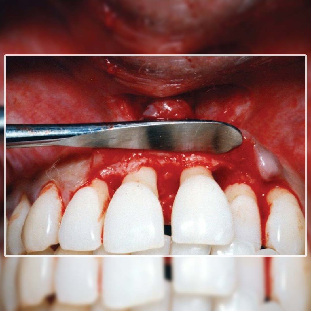 Waldent Periosteal Elevator Molt No.9 Premium (SE 9/111) | Dentalkart