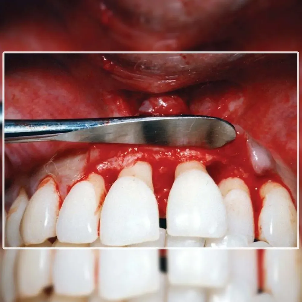 Periosteal Elevators: Buy Premium Quality Dental Surgery Tools Online ...