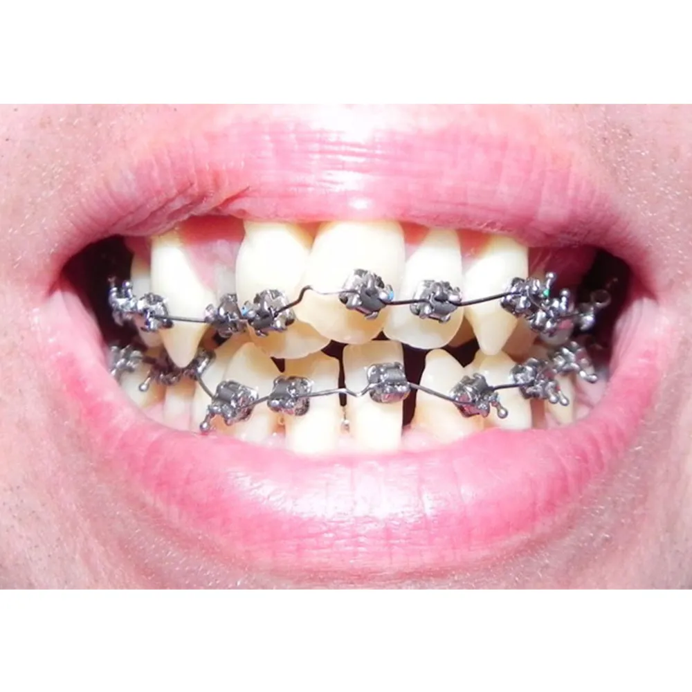 Buy D-Tech Precimax MIM MBT Prescription Brackets Online At Best Price ...