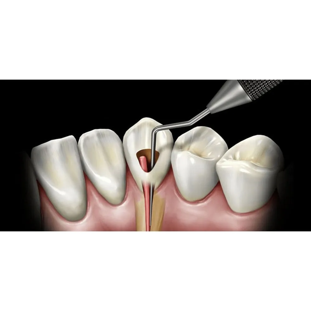 GDC RC Plugger (CC) -7 (1.00mm / 1.15mm) (RCP9/11) - Vertical Gutta ...