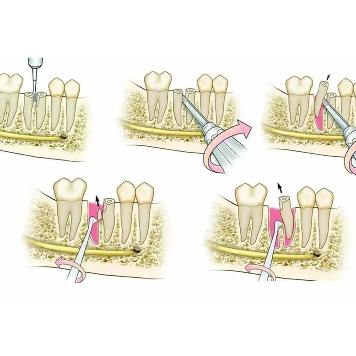 Buy Oracraft Root Elevator Set Of 9 In Pouch - RESP9 | Best Elevator ...