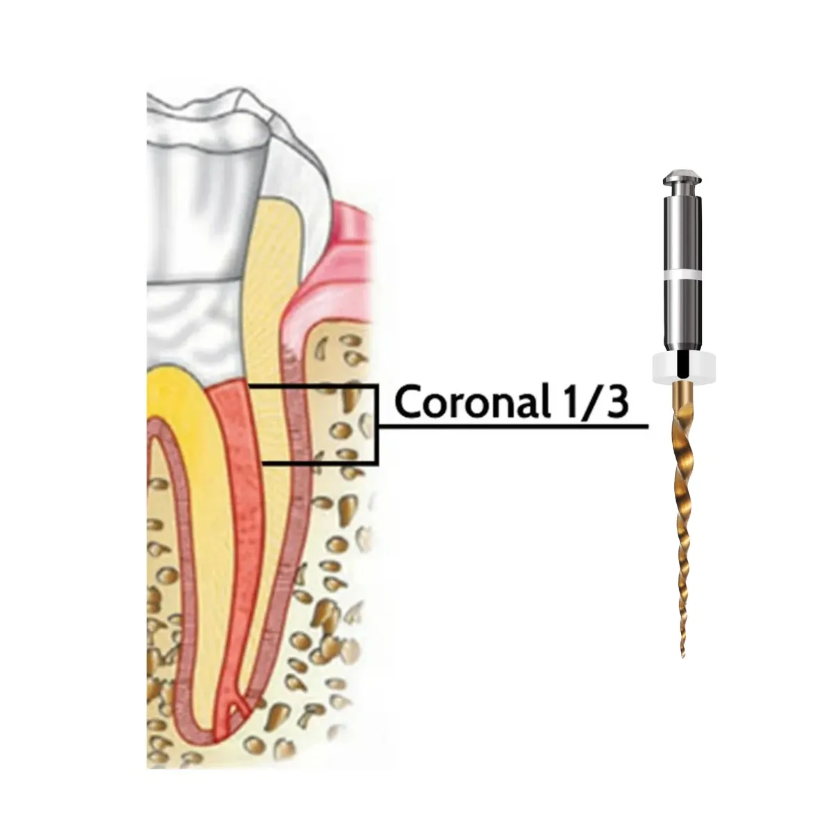 Waldent Retreatment Rotary Files - Efficient Removal of Obturators ...