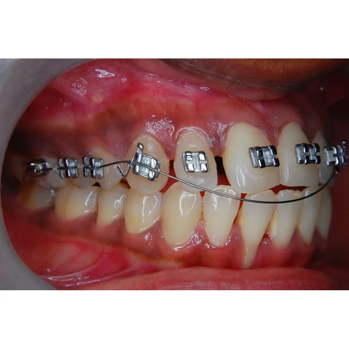 Prime Ortho Reverse Curve (RCS) Archwires Rectangular