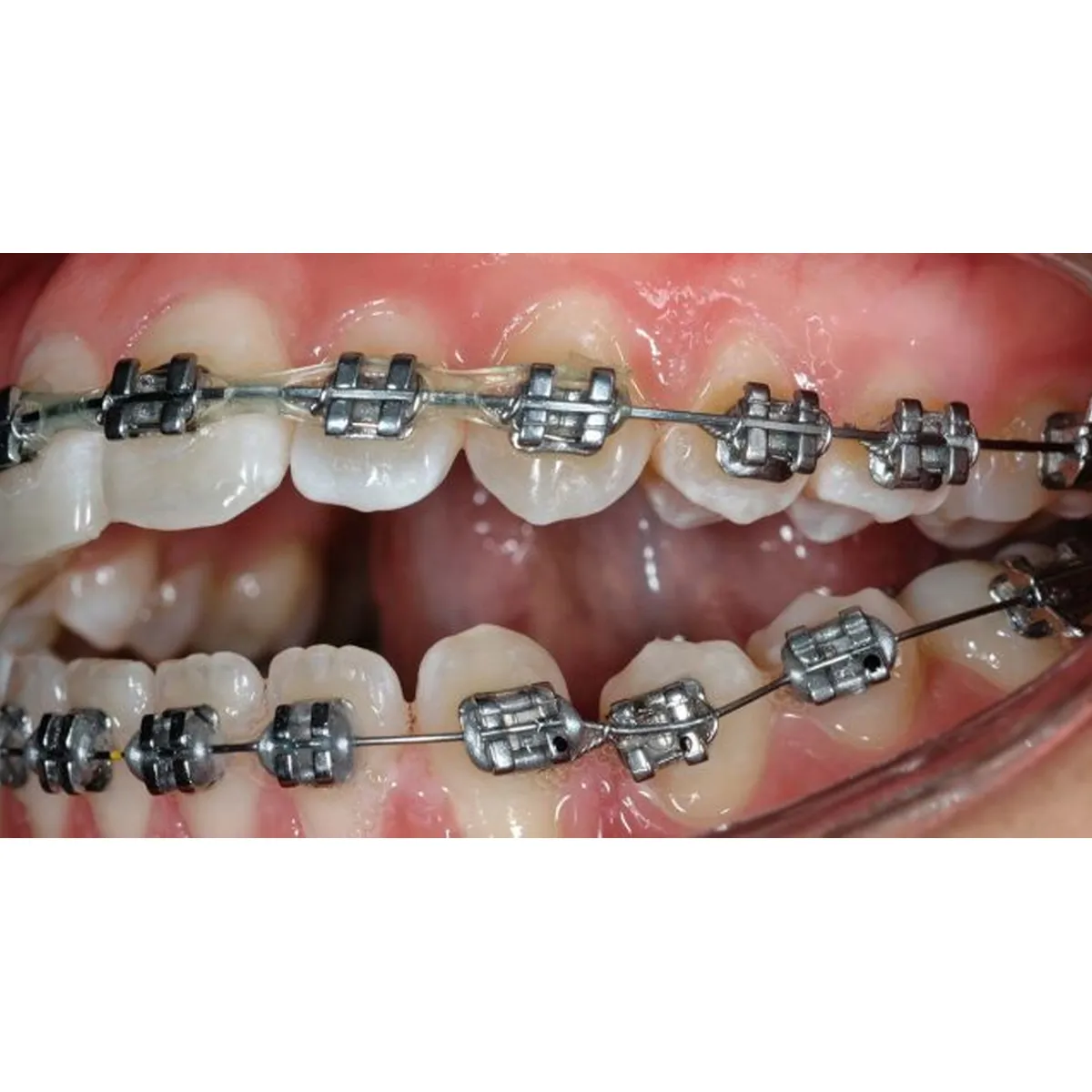 Prime Ortho Reverse Curve (RCS) Archwires Rectangular