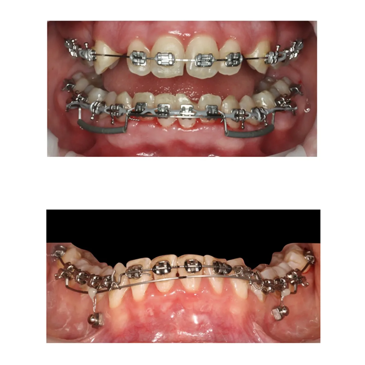 Prime Ortho Reverse Curve (RCS) Orthodontic Niti