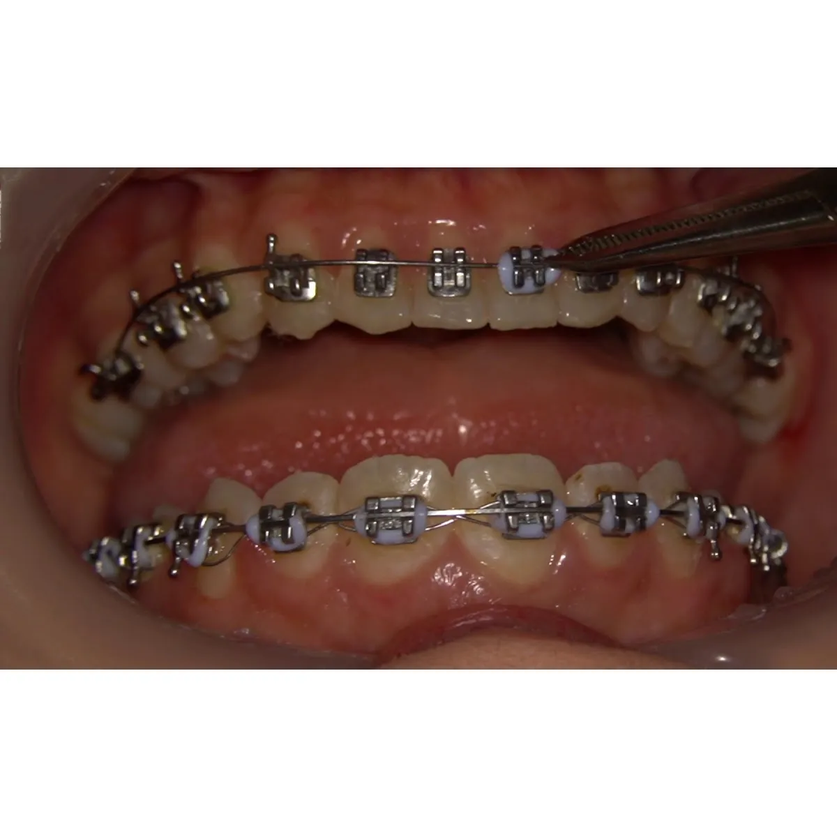 Prime Ortho Reverse Curve (RCS) Orthodontic Niti