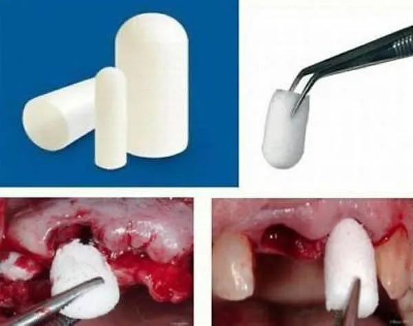 Buy Cologenesis ColoPlug Sterile Collagen Sponge - Pack of 1 Online at ...