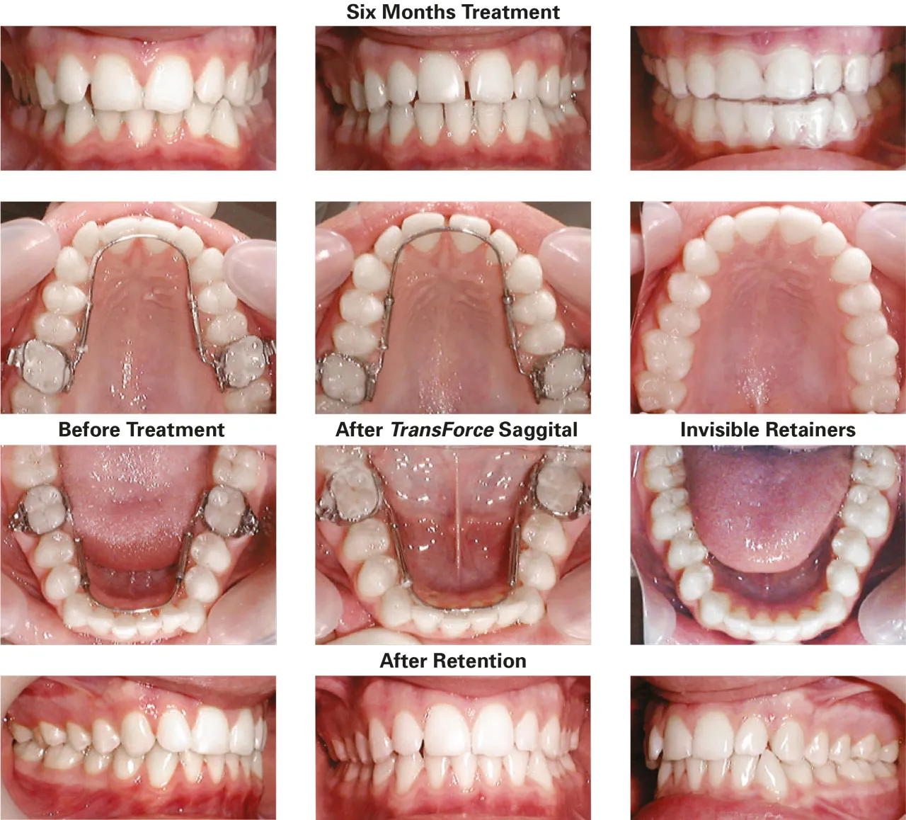 Shop Ortho Organizers Transforce Sagittal Appliance - Best Orthodontic ...