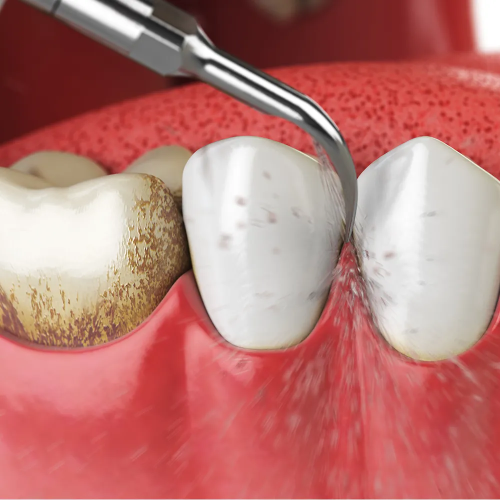 Ultrasonic Scaler Tips Kit: Buy Scaler Tips with DTE, NSK, EMS online ...