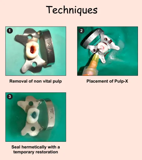 Buy Prevest Pulp X – Arsenic-Free Pulp Devitalizer at Dentalkart