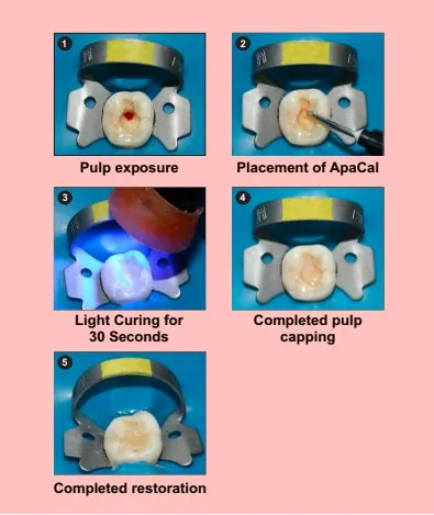 Buy Apacal Art by Prevest Direct- Dental Pulp Capping & Protection