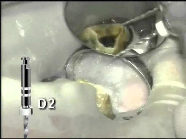 Retreatment Rotary files: Buy Dentsply Protaper Universal Retreatment ...