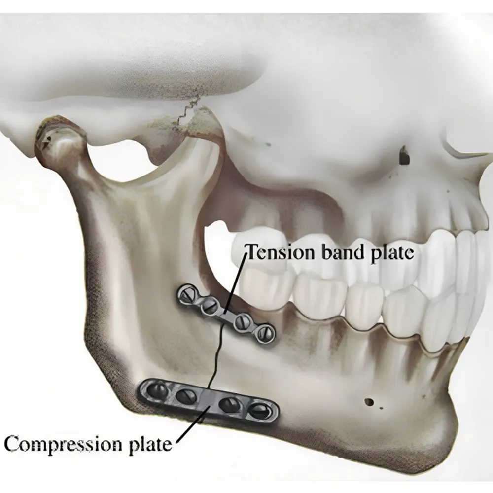Buy SK Surgical Titanium Single Slot Screws 2mm Online | Dentalkart