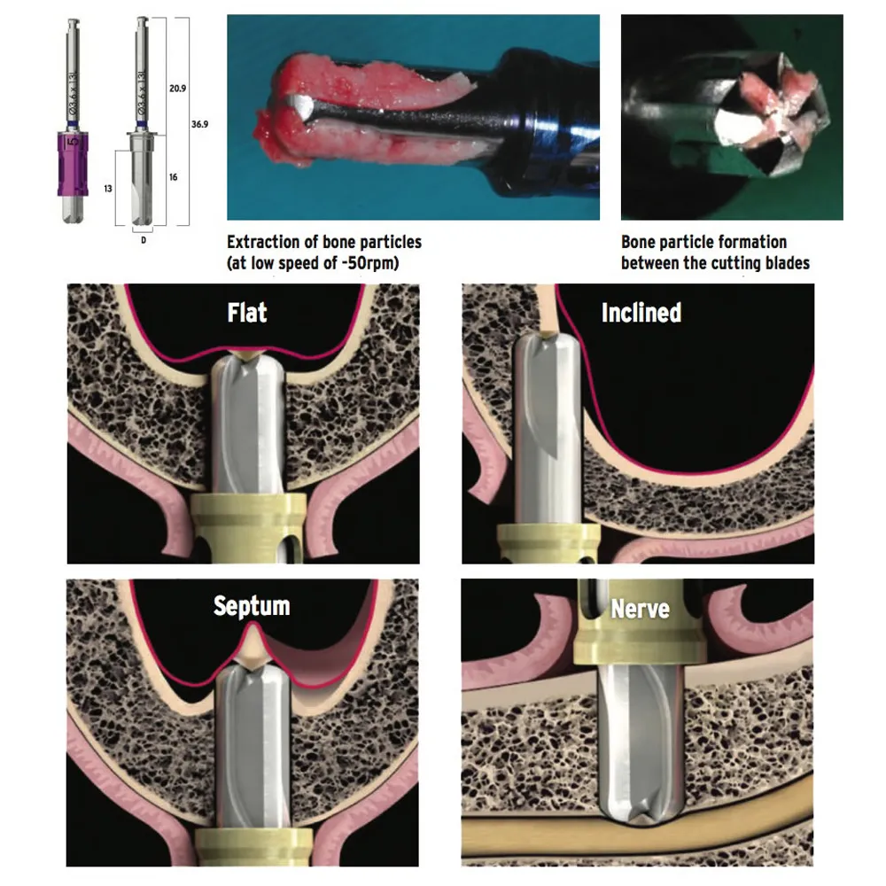 JULL-DENT Cestal Approach Sinus Cas-kit