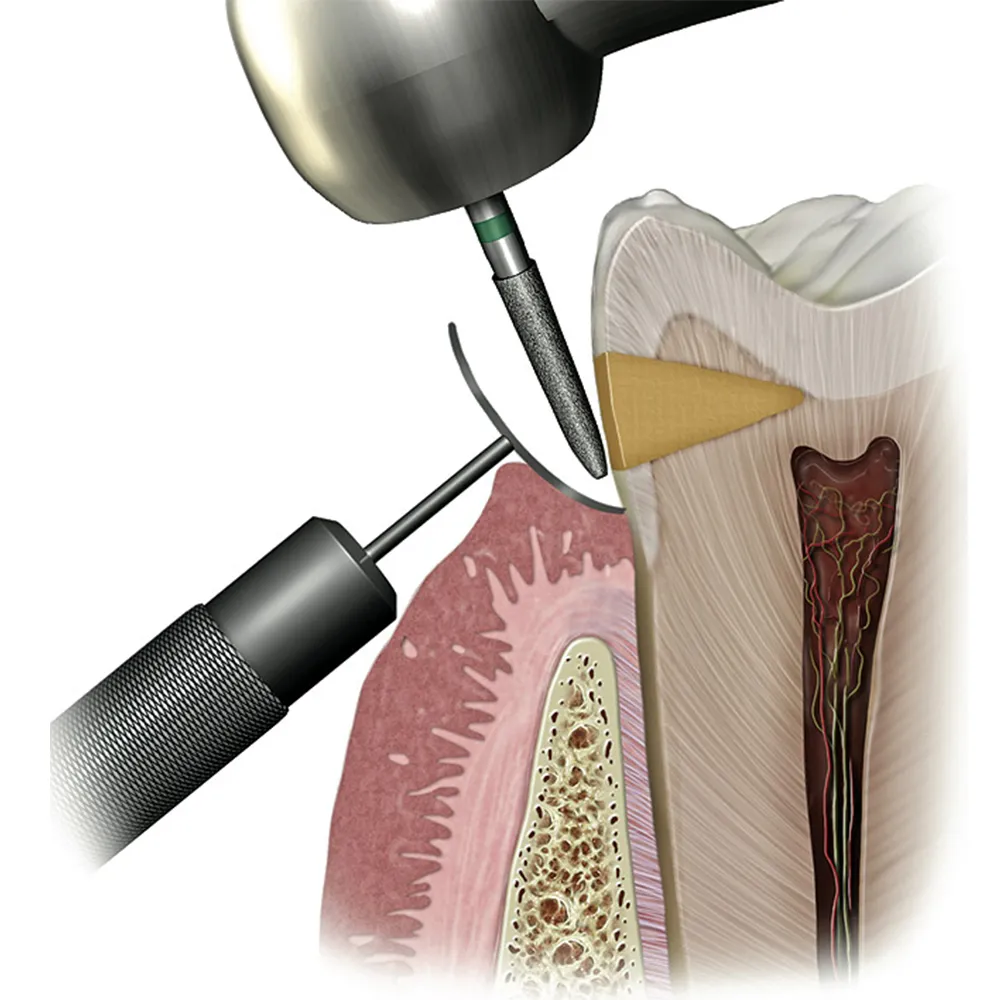 Julldent Socket Shield Retractor/Gingival