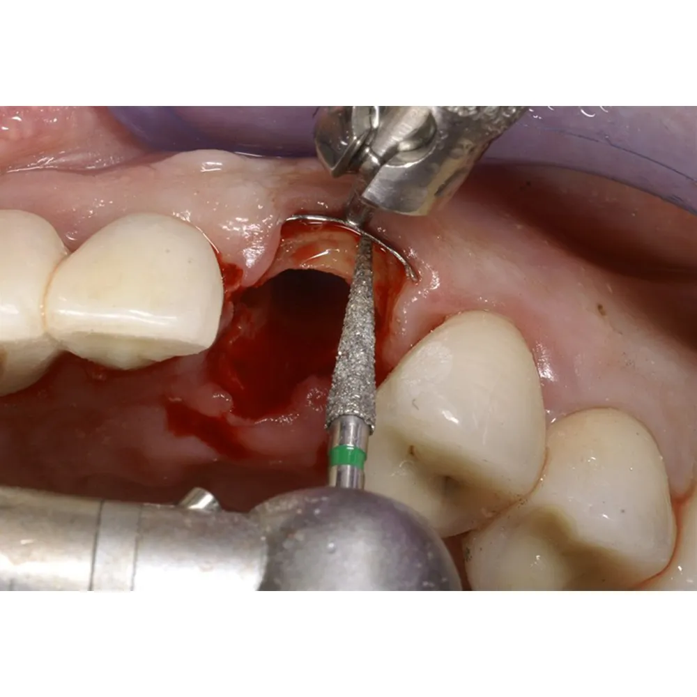 Julldent Socket Shield Retractor/Gingival