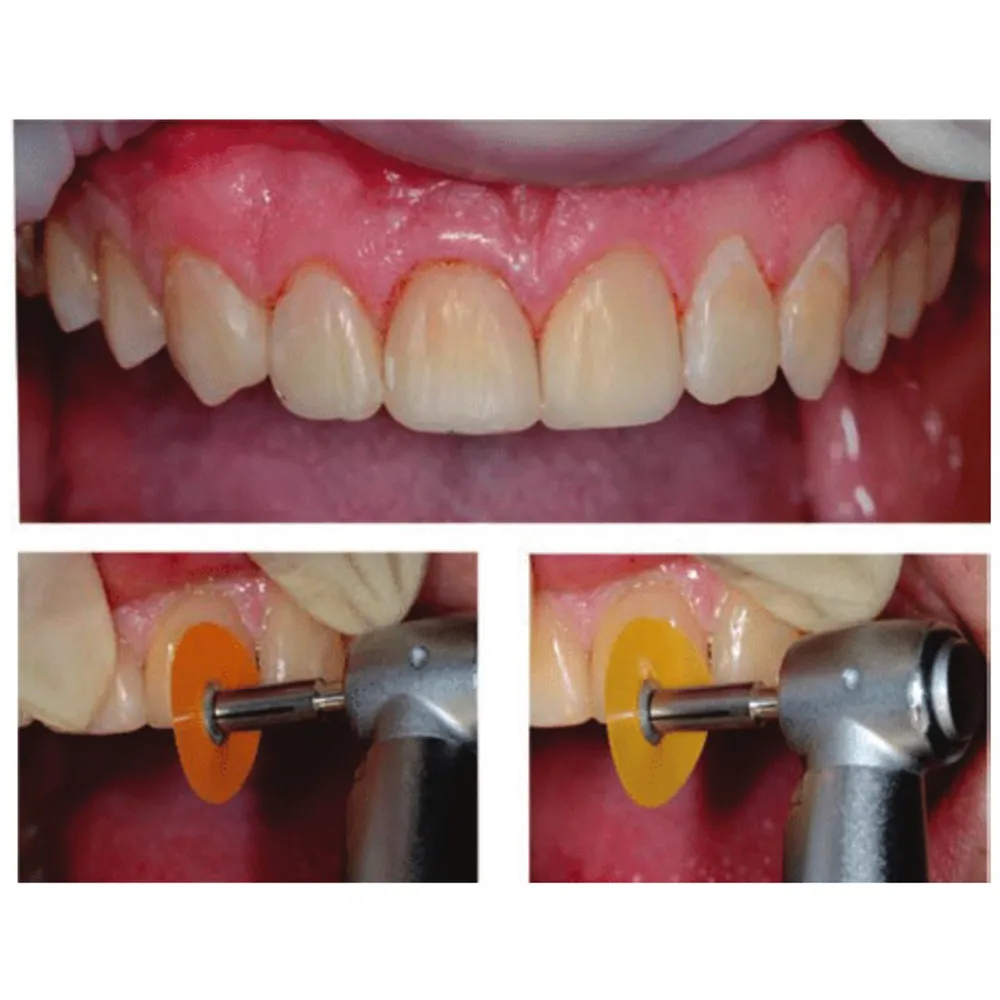 Buy 3M ESPE Sof-Lex Polishing Discs Kit & Accessories- Dentalkart