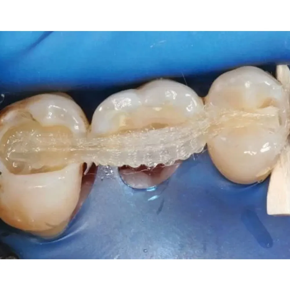 Polydentia Fiber-Splint With Clips