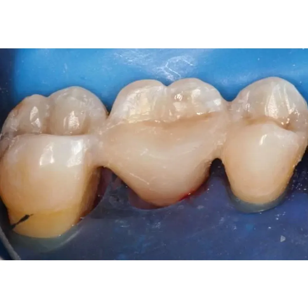 Polydentia Fiber-Splint With Clips