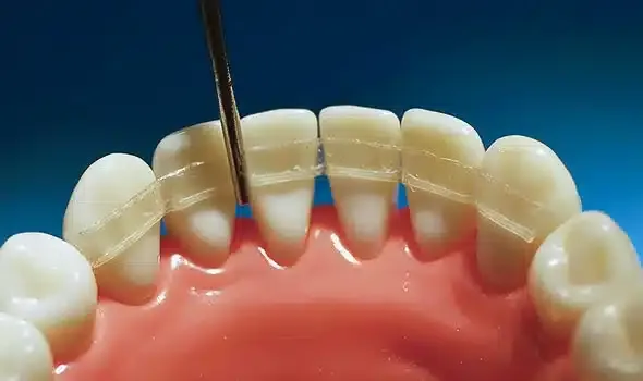 Buy NT StickOn Fiber Splint Material Online | DentalKart