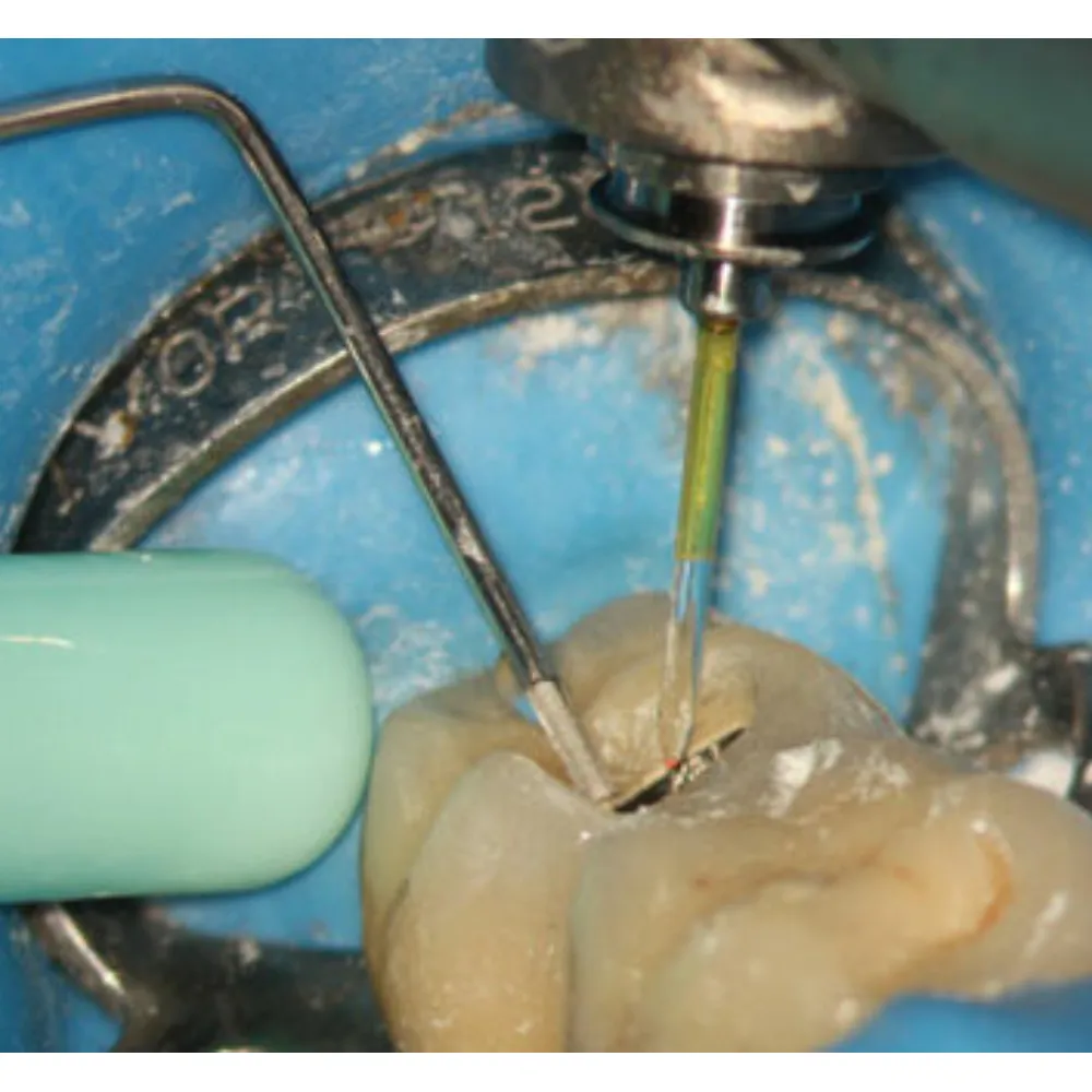 Buy GDC Spreaders -1 (Rcsd11t) Online at Best Price | Dentalkart.com