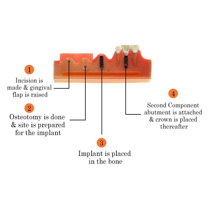 iDENTical Steps for Implant Model M2018 : with Detailed Implant ...