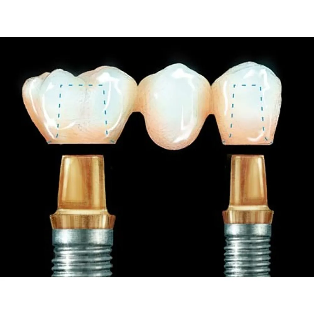 Adin CloseFit NP Straight Abutment