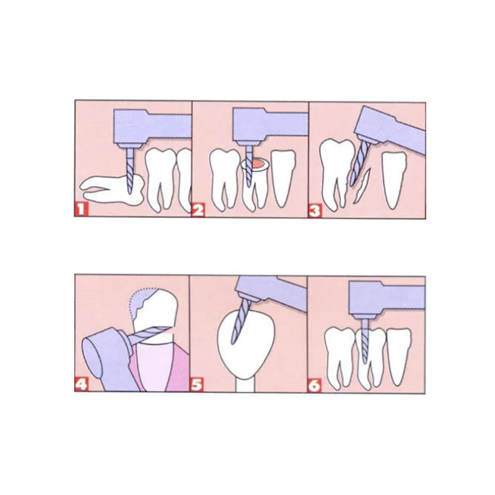 Superendo Zekrya Carbide Burs : Buy Premium Tungsten Carbide Dental ...