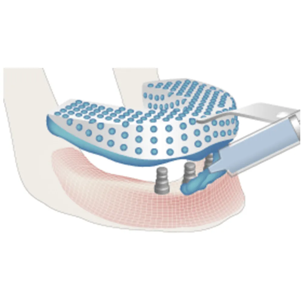 Xcem Conical Impression Coping Transfer - Non Hex