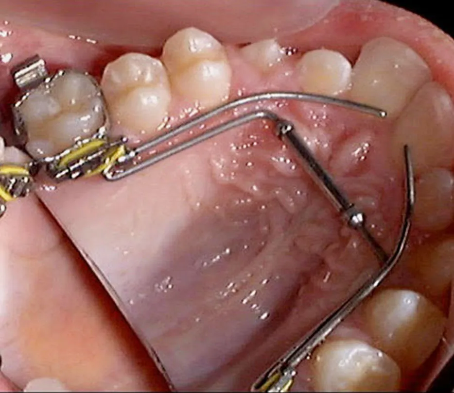 Buy Ortho Organizers Transforce Transverse Appliance - Best Orthodontic ...