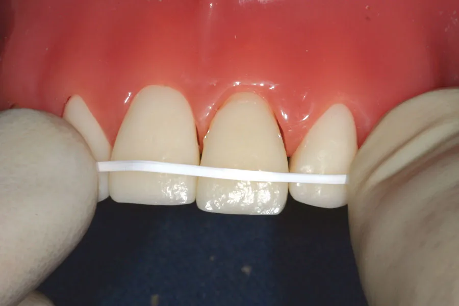 Buy Online Ribbond Ribbon Fiber Splint Kit - Dentalkart