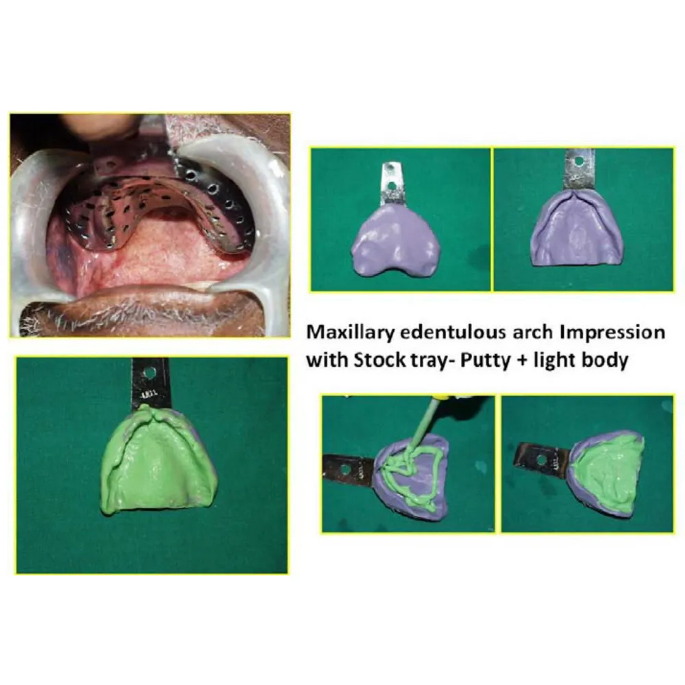 Buy GDC Edentulous Perforated Impression Trays S/8 Kit with Angled ...