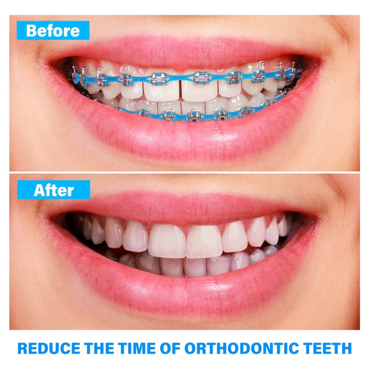Buy U Ortho E-Chain (15 ft) - Continuous White Online at Best Price ...