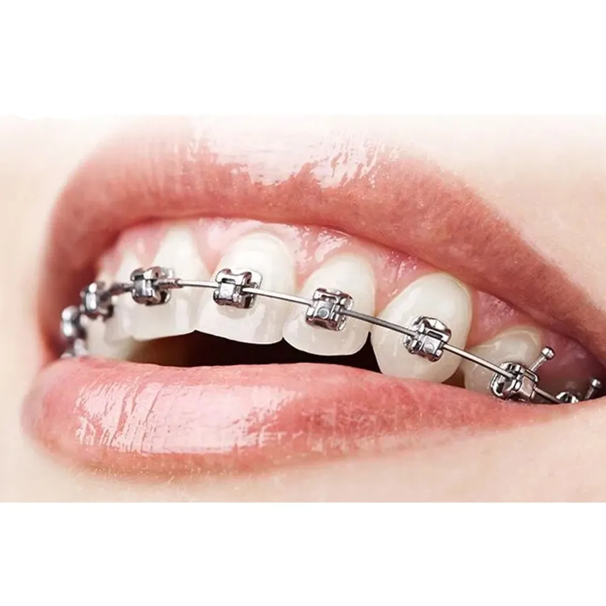 OrthoMetric Ultra-P Self Ligating Bracket Kit + Arch Sequence