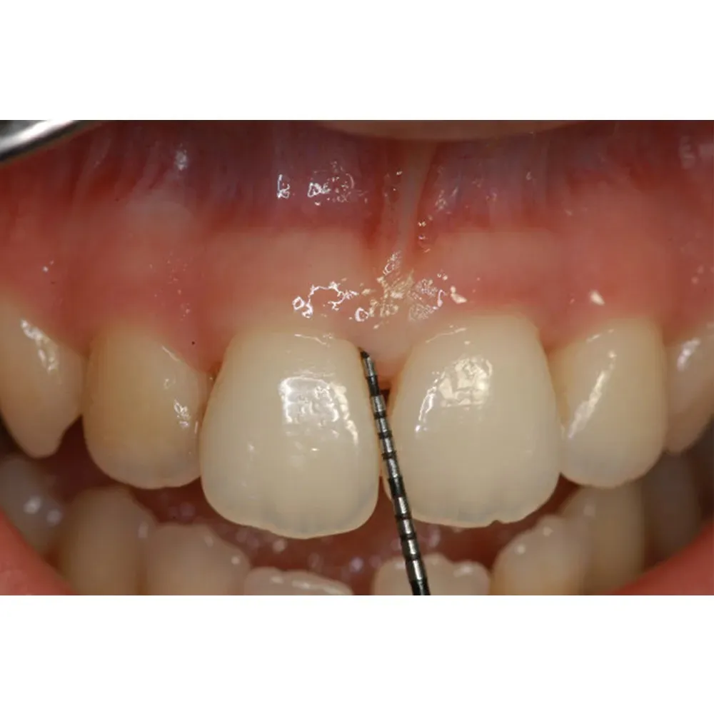 Waldent UNC 15 Probes