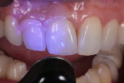 Buy Now GC G-Cem One Paste Pak Starter Kit Online - DentalKart