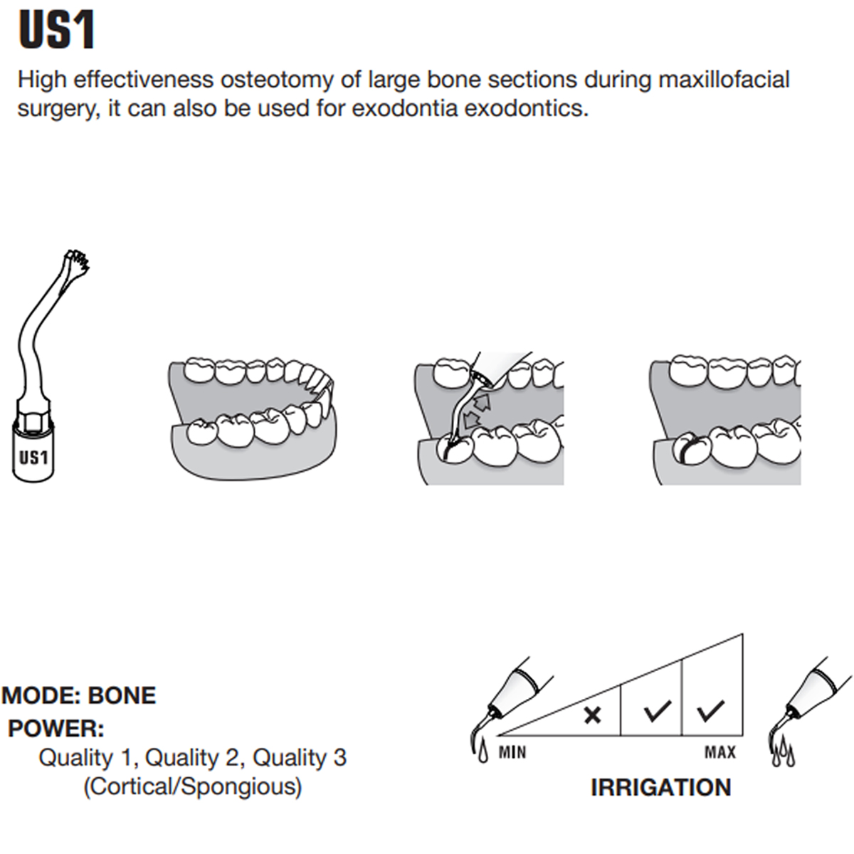 Woodpecker Piezo Bone Surgery Tips