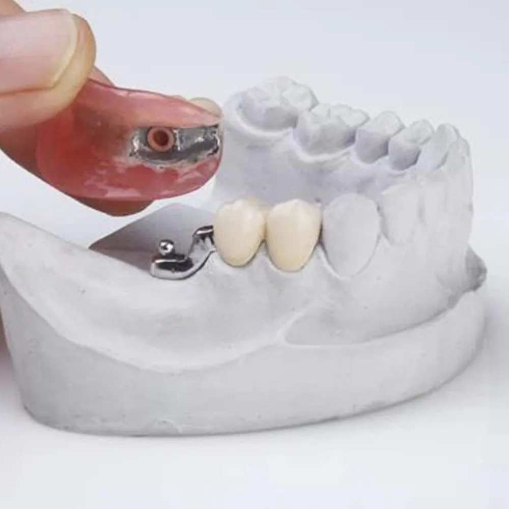 Adin Ball Attachment Replica Abutment