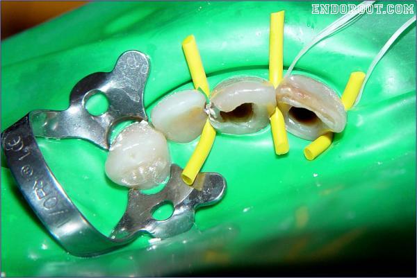 Coltene Wedjet - Small