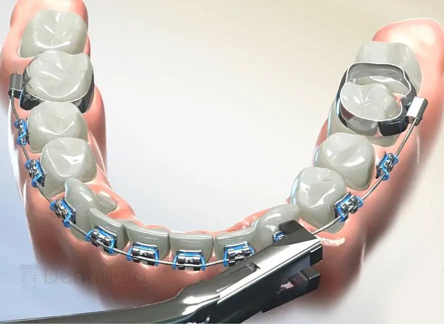 Buy Waldent Orthodontic Bracket Remover Offset Pliers | Best Bracket ...